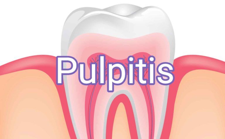 Pulpitis Dental: Tipos de Pulpitis y Tratamientos【2020】