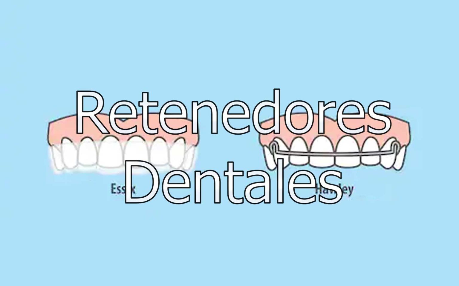 Retenedores Dentales: Tipos, Uso y Precios en【2020】