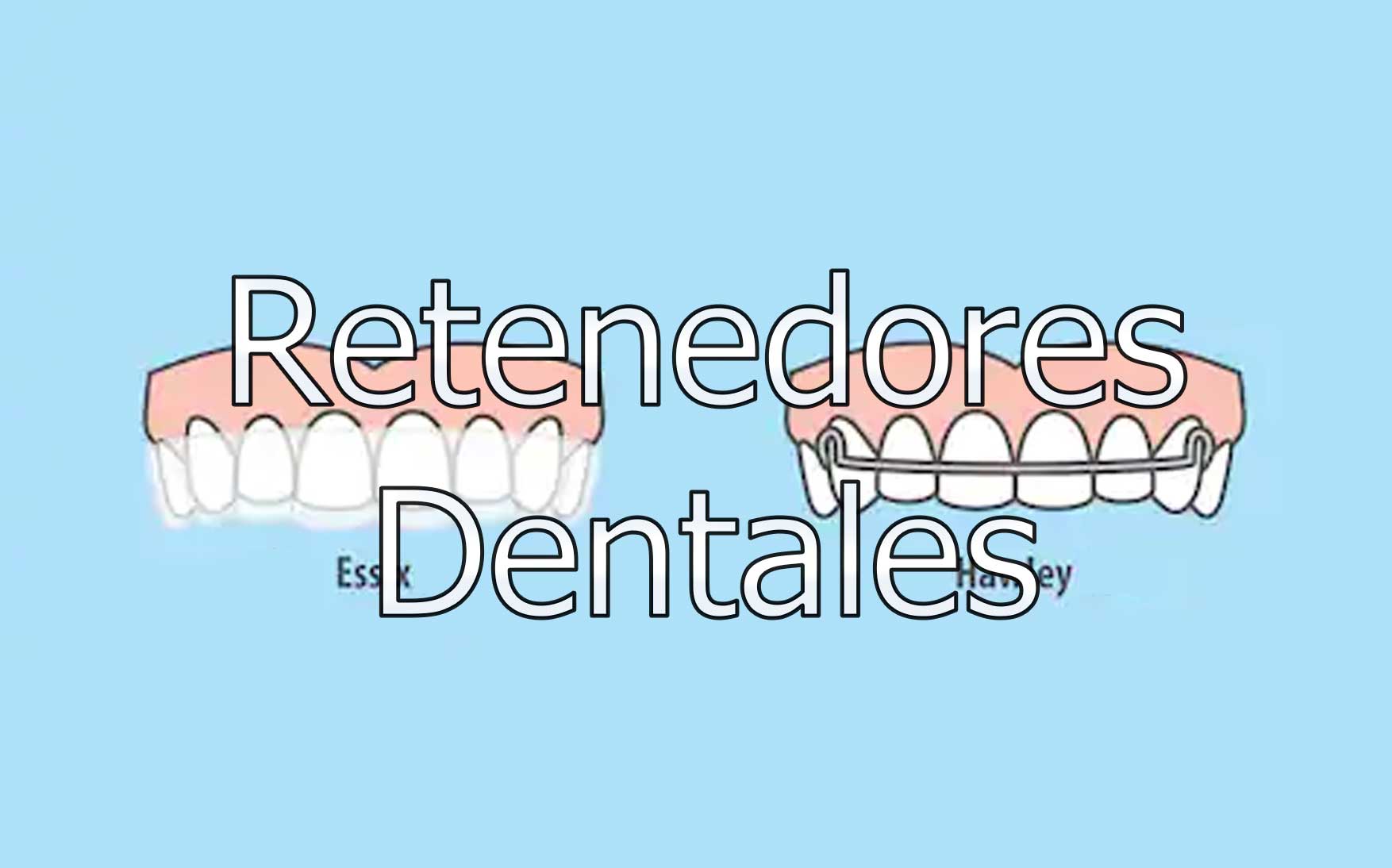 Retenedores Dentales: Tipos, Uso y Precios en【2020】