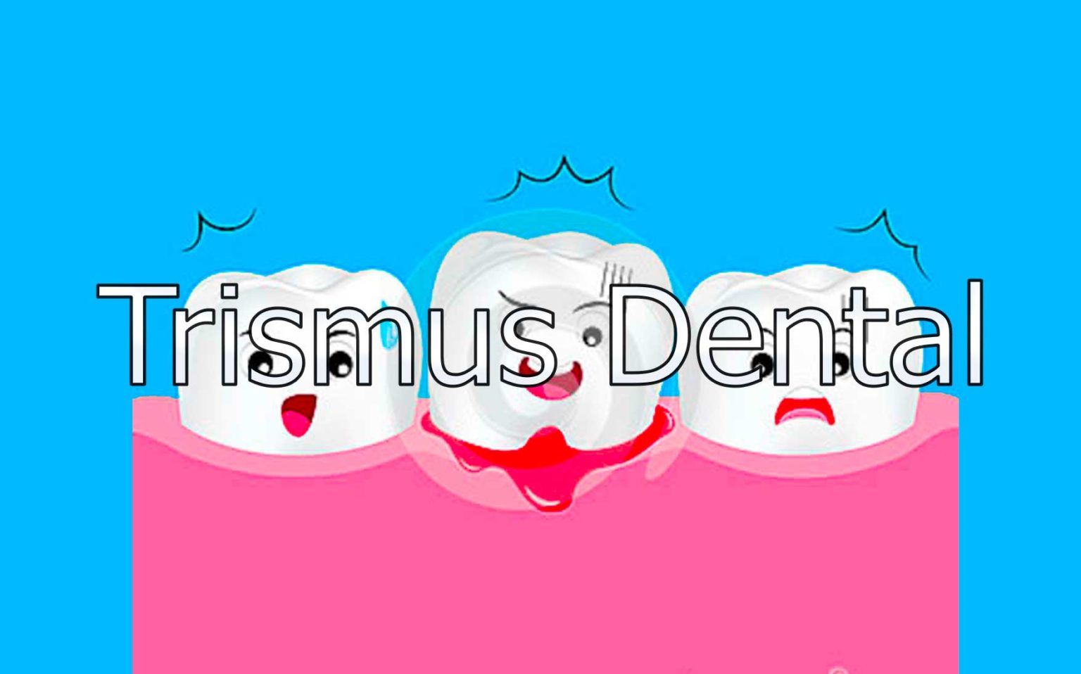 Trismus: Causas, Síntomas y Tratamientos este【2020】